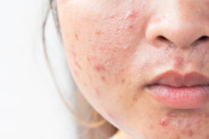 Acne After Stopping Birth Control and How To Heal Your Skin - Dr ...