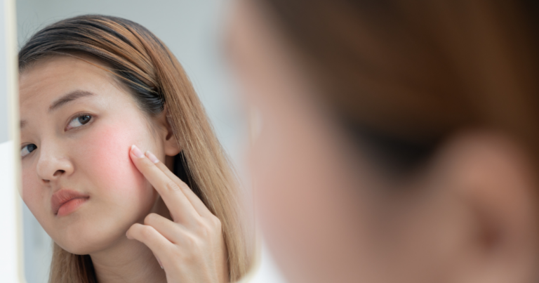 What Causes Rosacea on Face: Treating Rosacea Naturally