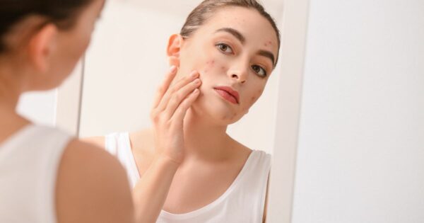 Acne and Polycystic Ovary Syndrome: Hormone and Skin Care Treatment