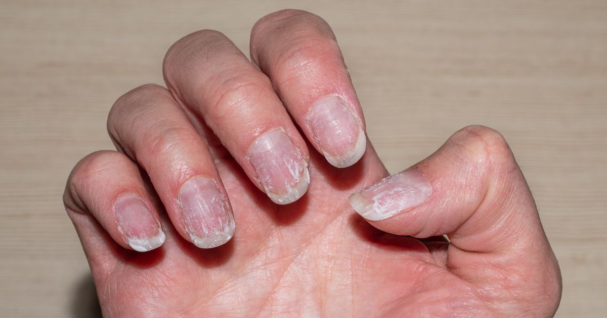 What Your Fingernails Say About Your Health