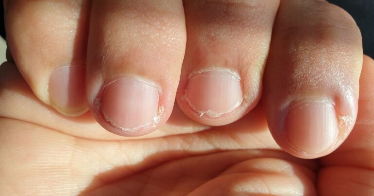 What Your Fingernails Say About Your Health