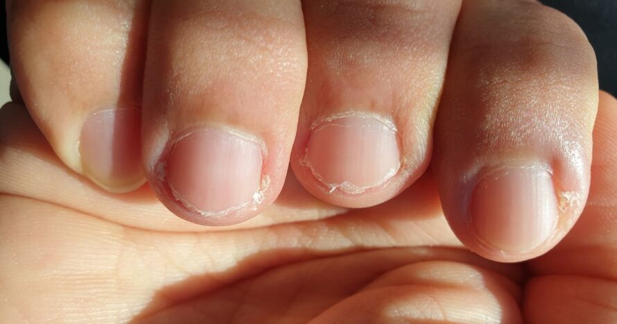 What Your Fingernails Say About Your Health