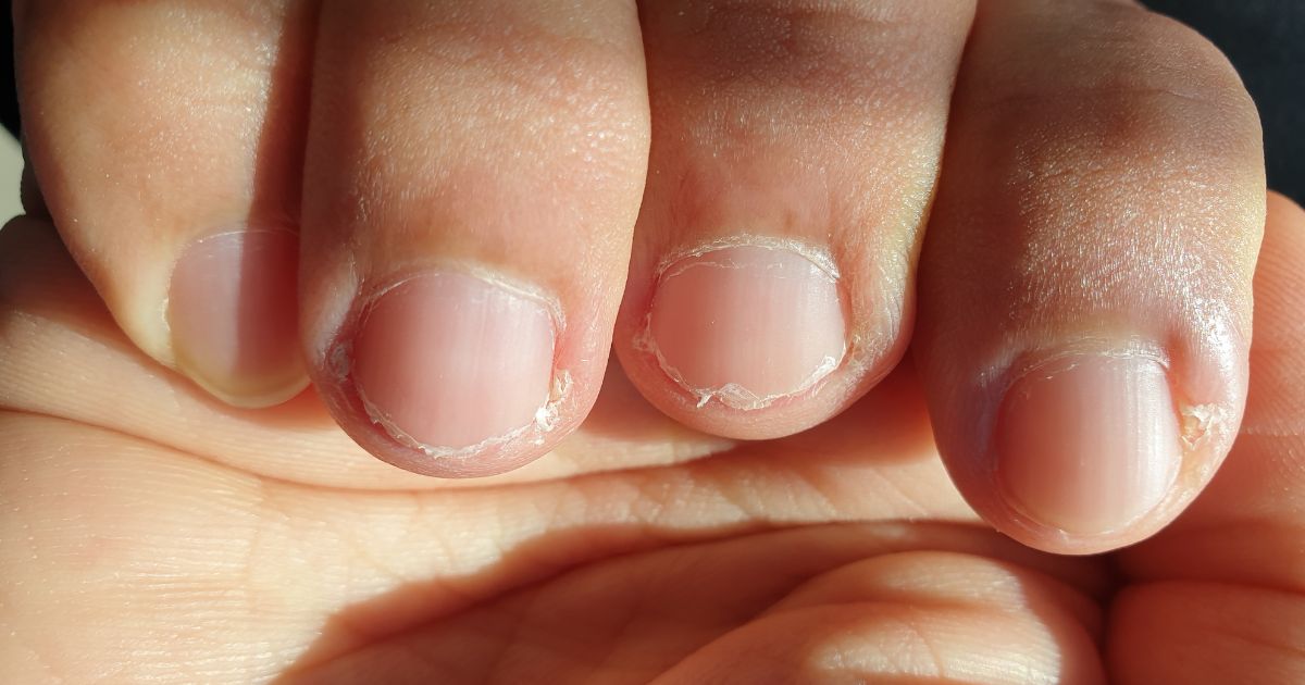 What Your Fingernails Say About Your Health