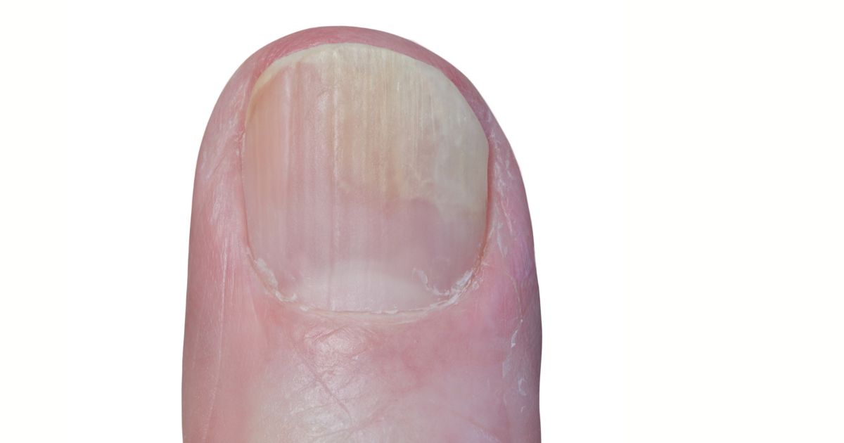 What Your Fingernails Say About Your Health