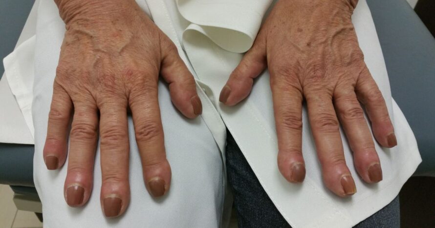 What Your Fingernails Say About Your Health